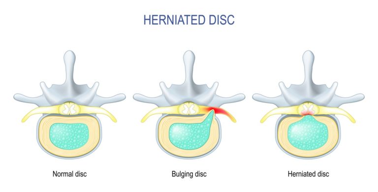 illustration-of-herniated-disc - Bend Total Body Chiropractic